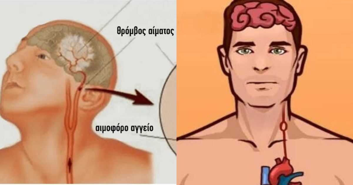 Tι πρέπει να κάνουμε σε περίπτωση εγκεφαλικού: Σώζει ζωές και παίρνει ...